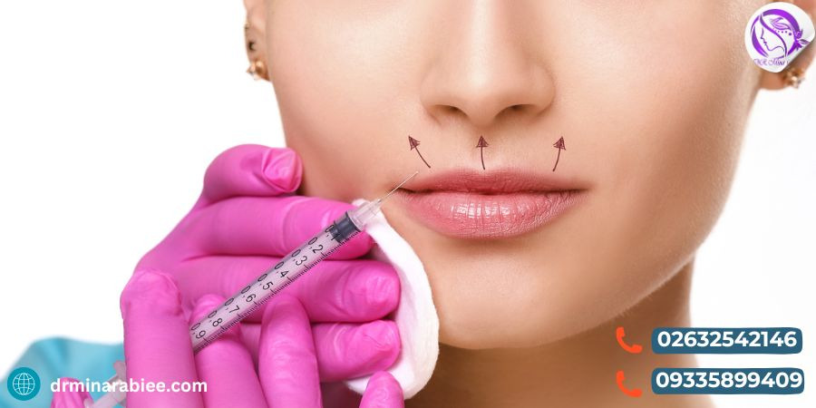 روش تزریق ژل لب مدل باربی - مطب دکتر مینا ربیعی